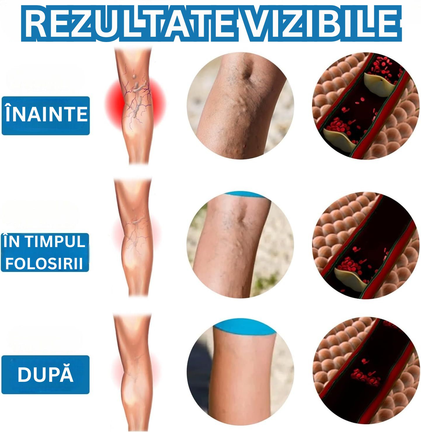 Spray pentru Varice - SUPERTIA - Super preturi, super calitate